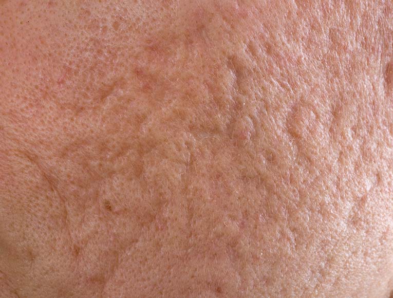 Melbourne Chemical Peel Treatments | Professional & Safe Skin Peels